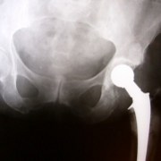 Minimally Invasive Hip Replacement Surgery